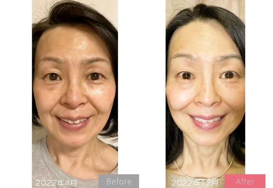 OKAOキントレの効果 Vラインの顎にと注目 | 【札幌顔ヨガ】即解決！シワたるみブルドッグ顔、マリオネットラインなどに悩んだらここ！ 顔ヨガ ...